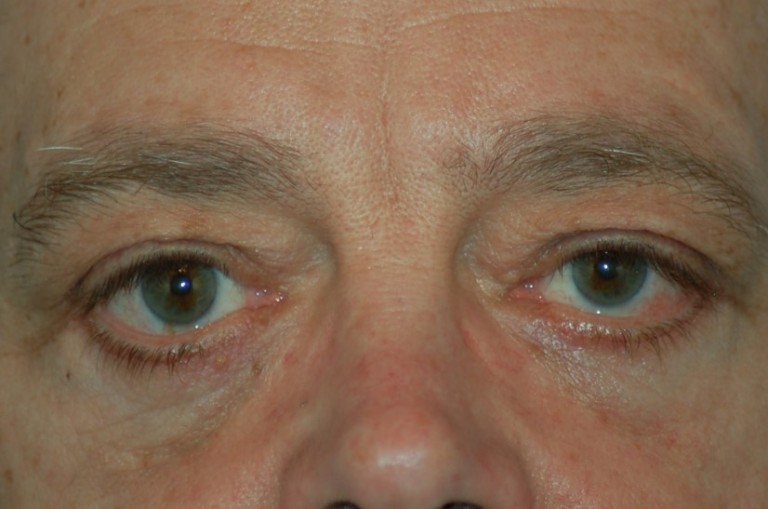 Lower Eyelid Blepharoplasty | The Center for Facial Plastic Surgery