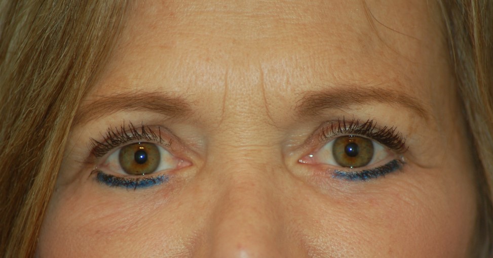 Lower Eyelid Blepharoplasty | The Center for Facial Plastic Surgery