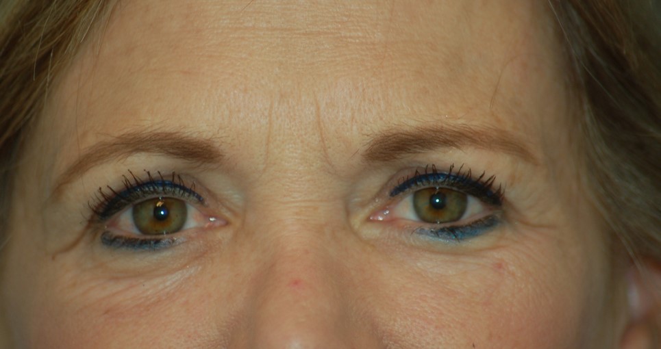 Lower Eyelid Blepharoplasty | The Center for Facial Plastic Surgery