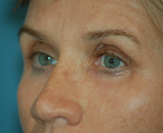 Laser Skin Resurfacing | The Center for Facial Plastic Surgery