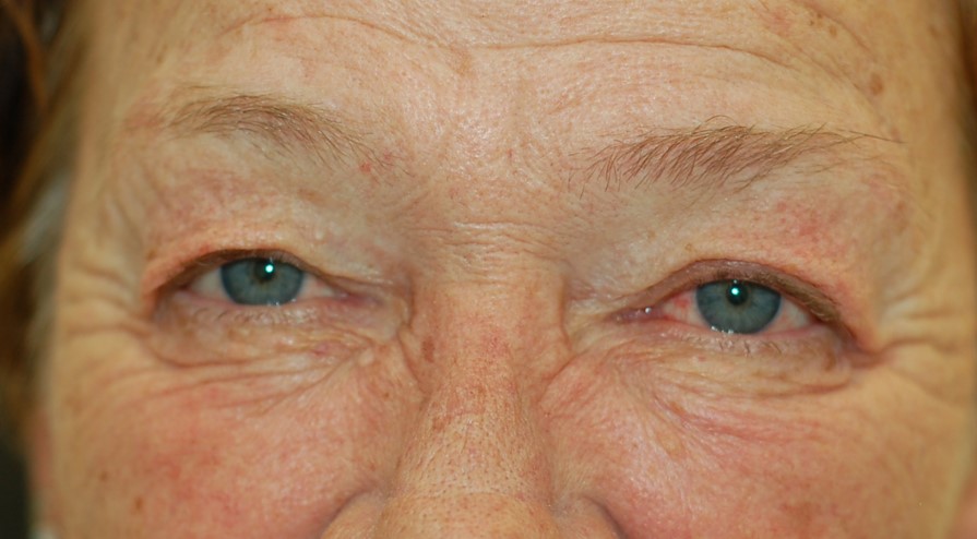 Lower Eyelid Blepharoplasty | The Center for Facial Plastic Surgery