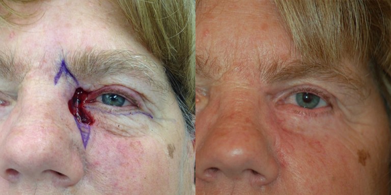 Left lower eyelid - Dr. M. Been | The Center for Facial Plastic Surgery